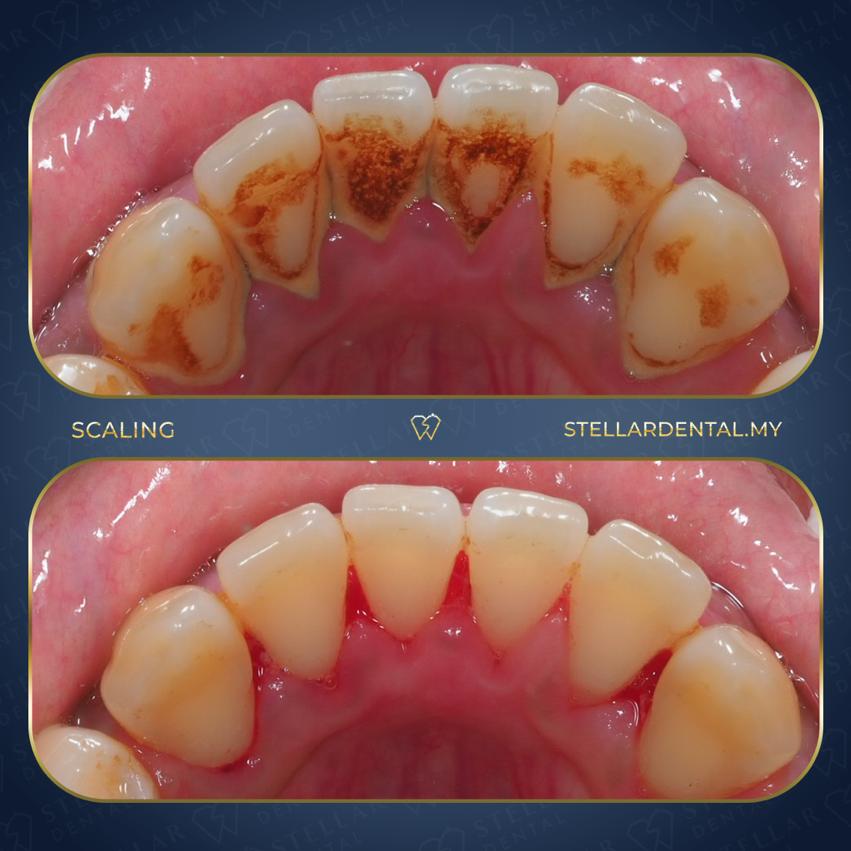 Teeth Scaling: Teeth Cleaning Treatment - Stellar Dental Teeth Scaling: Teeth Cleaning Treatment - Stellar Dental